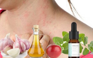 Tratamiento natural para hongos en la piel: Consejos efectivos - Buena ...